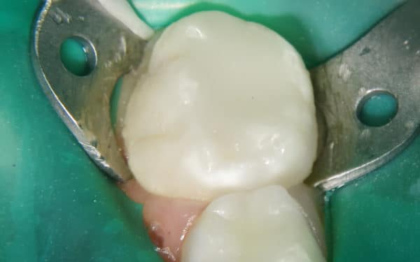 Carie sur dent de lait : que faire ? - Kids dental paris